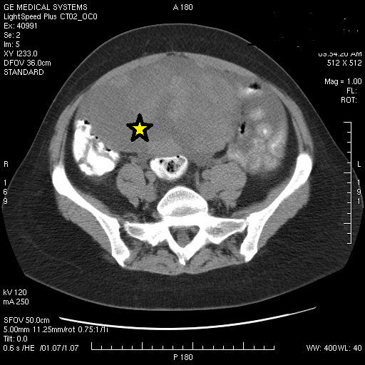 Ascitis en una mujer joven asintomática / Ascites in a non-symptomatic ...
