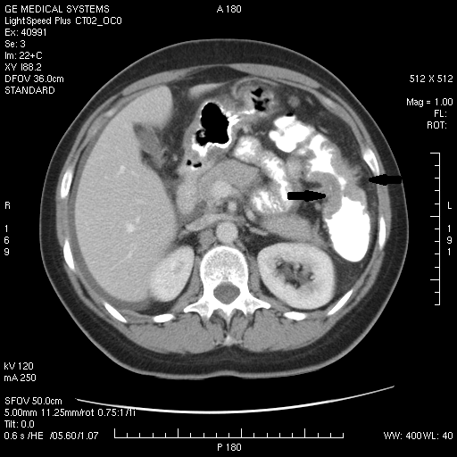 Ascitis en una mujer joven asintomática / Ascites in a non-symptomatic ...