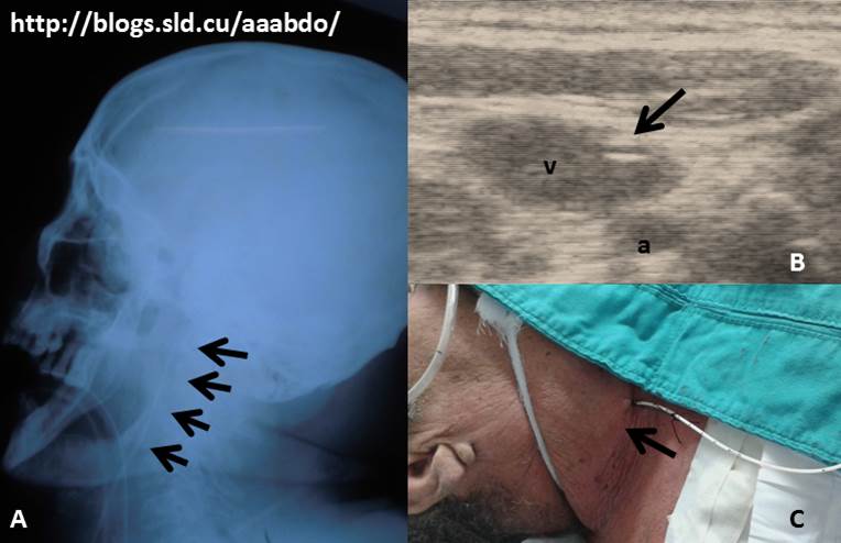Cateterización del golfo yugular guiada por ecografía en tiempo real ...