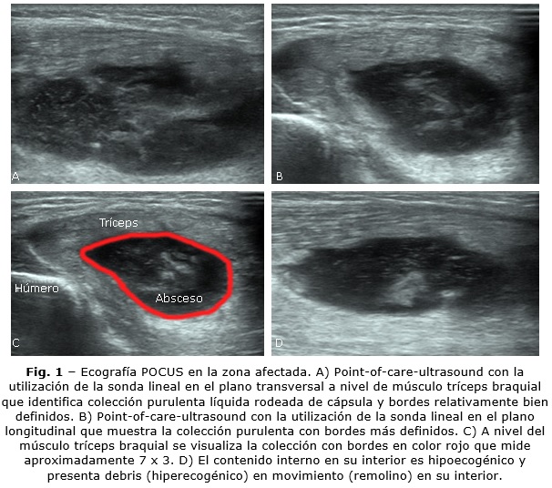 Utilidad de la ecografía en la toma de decisiones sobre la celulitis o ...