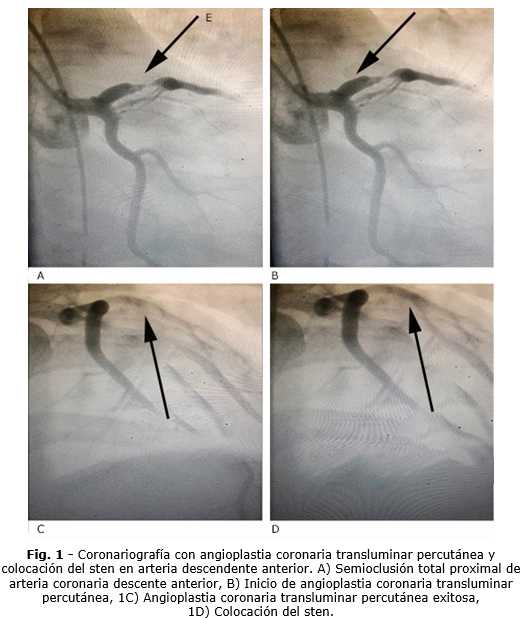 Síndrome de Wellens y patrón de Winter en deportista joven | Vega ...
